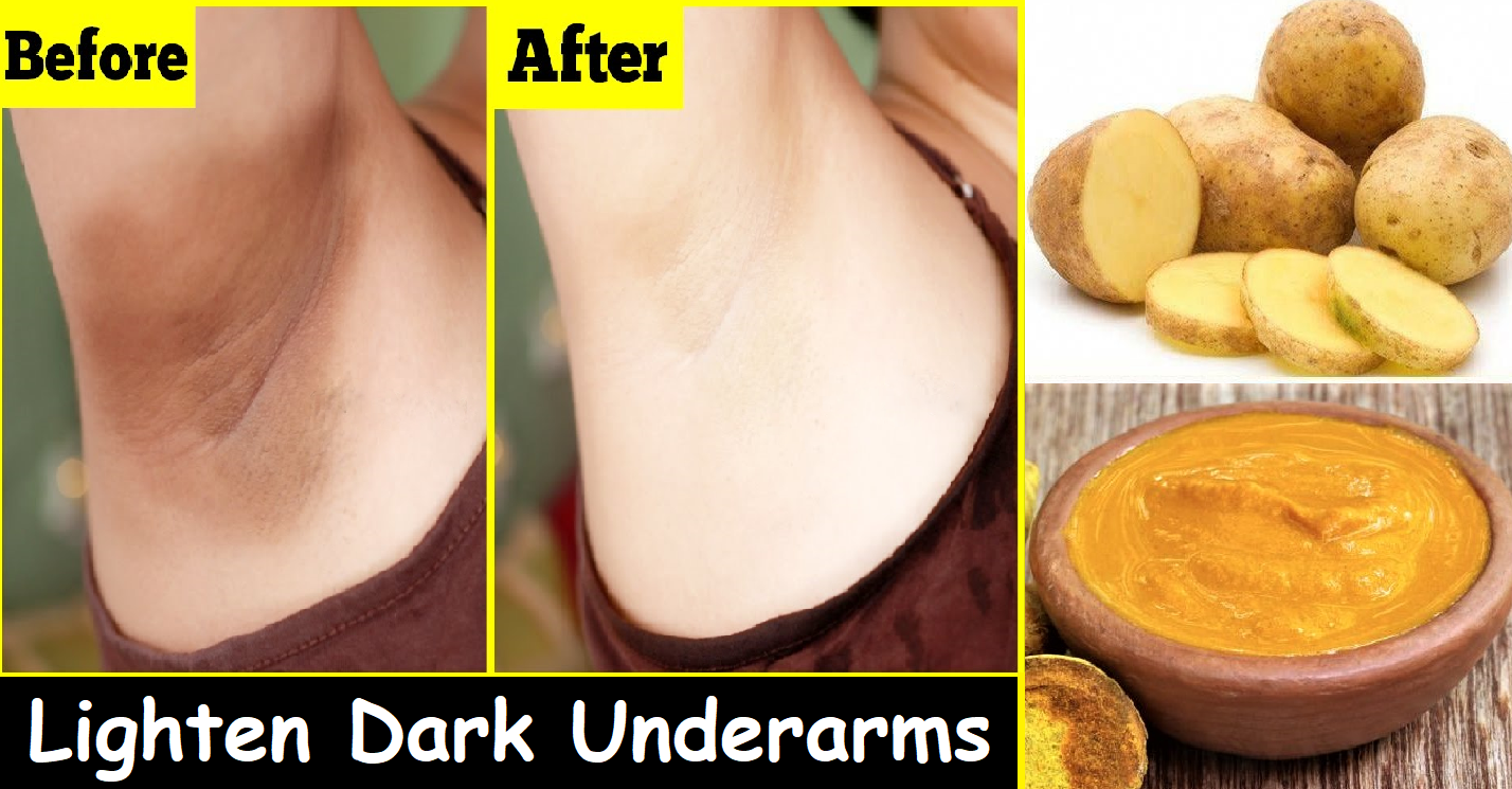 6 Home Remedies to Lighten Dark Underarms | Get rid of Dark Underarms